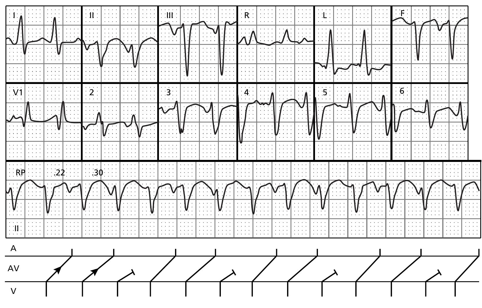 30 ventriculoatrial conduction (3:2). interval between a