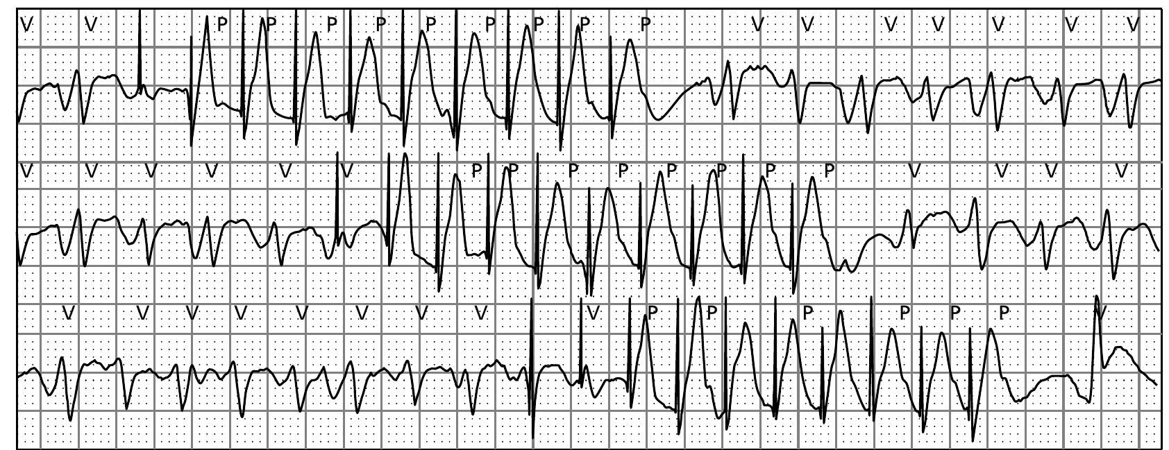 6 overdrive pacing of ventricular tachycardia. three bursts