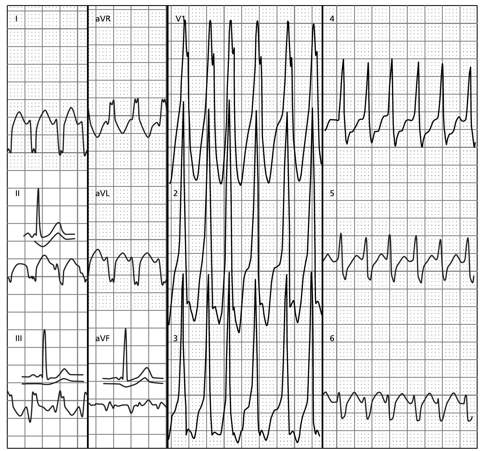 6.41. identify the abnormality in the following tracing