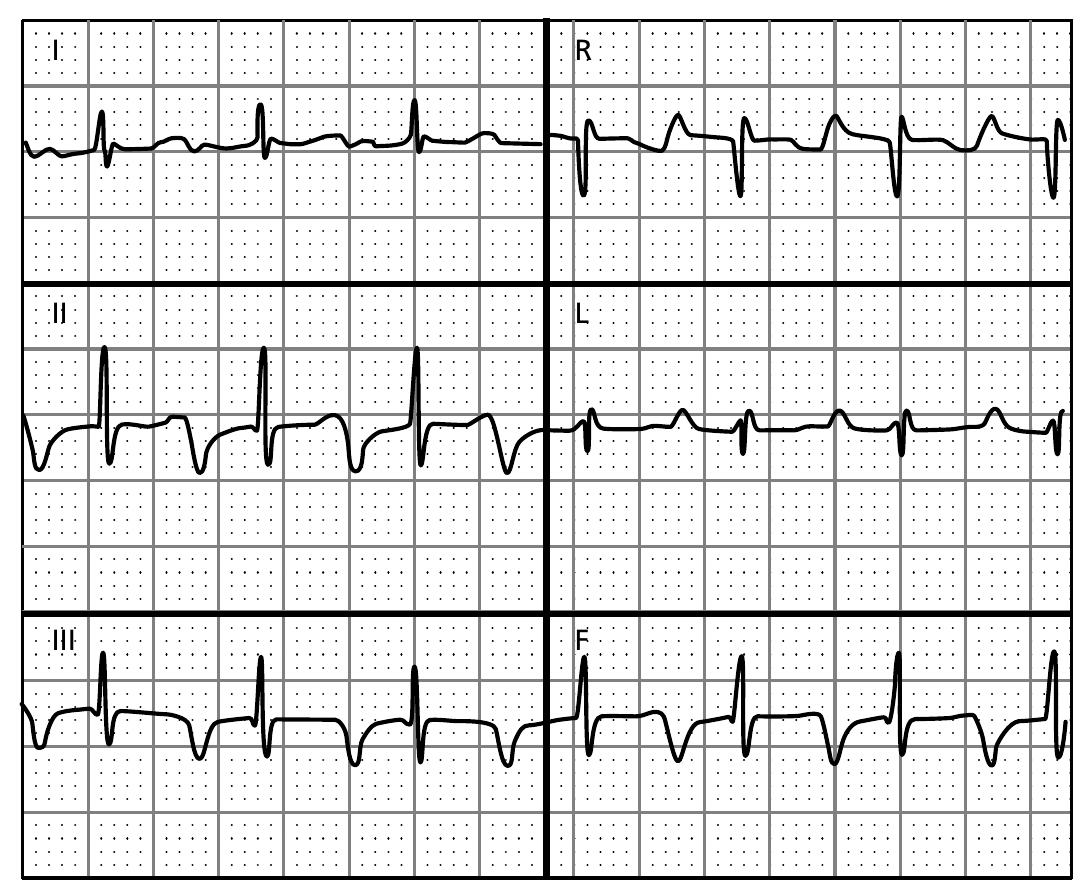 Identify the abnormalities in the following seven tracings.