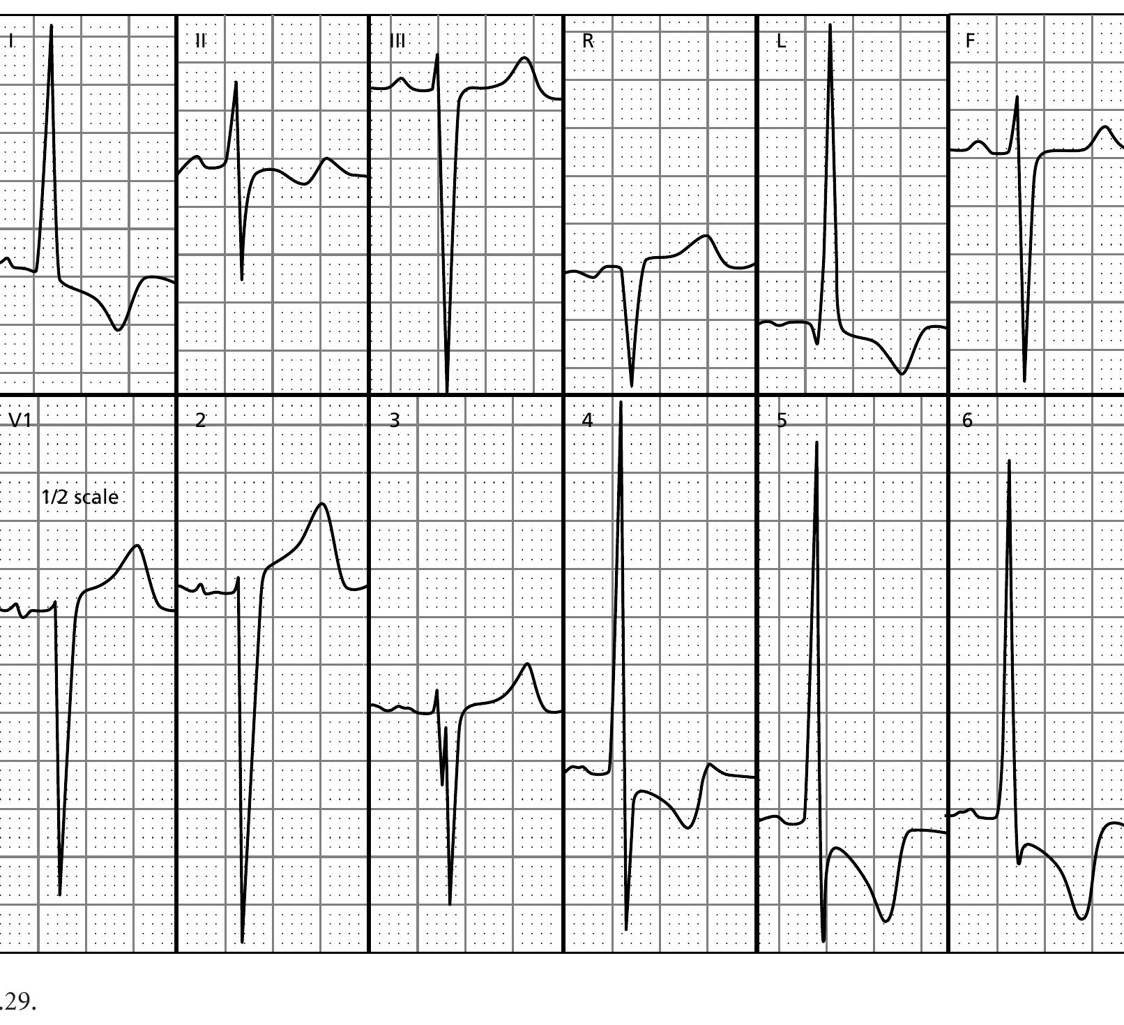 Table 10 - from ECG interpretation