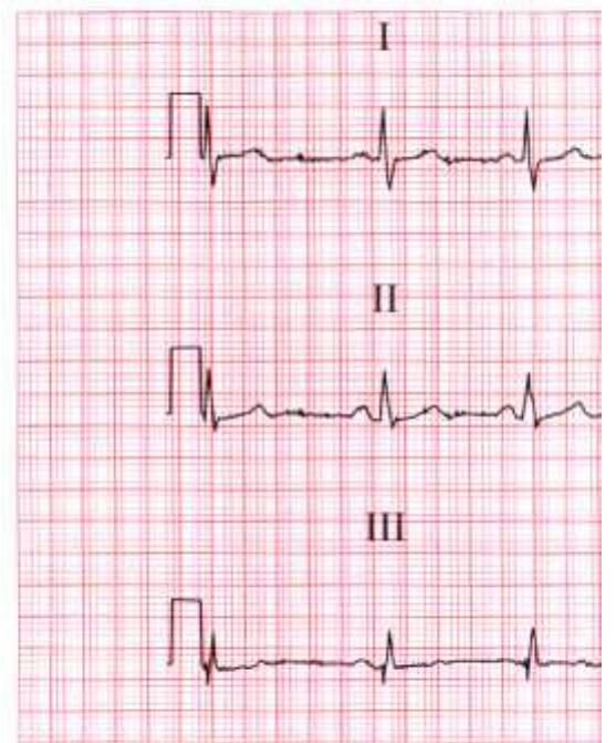 26 right bundle branch block with atrial septal defect