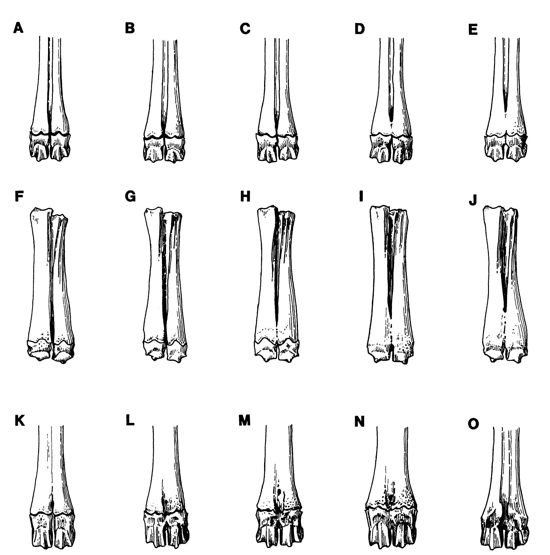 Developmental stages of the fusion of the metatarsus and