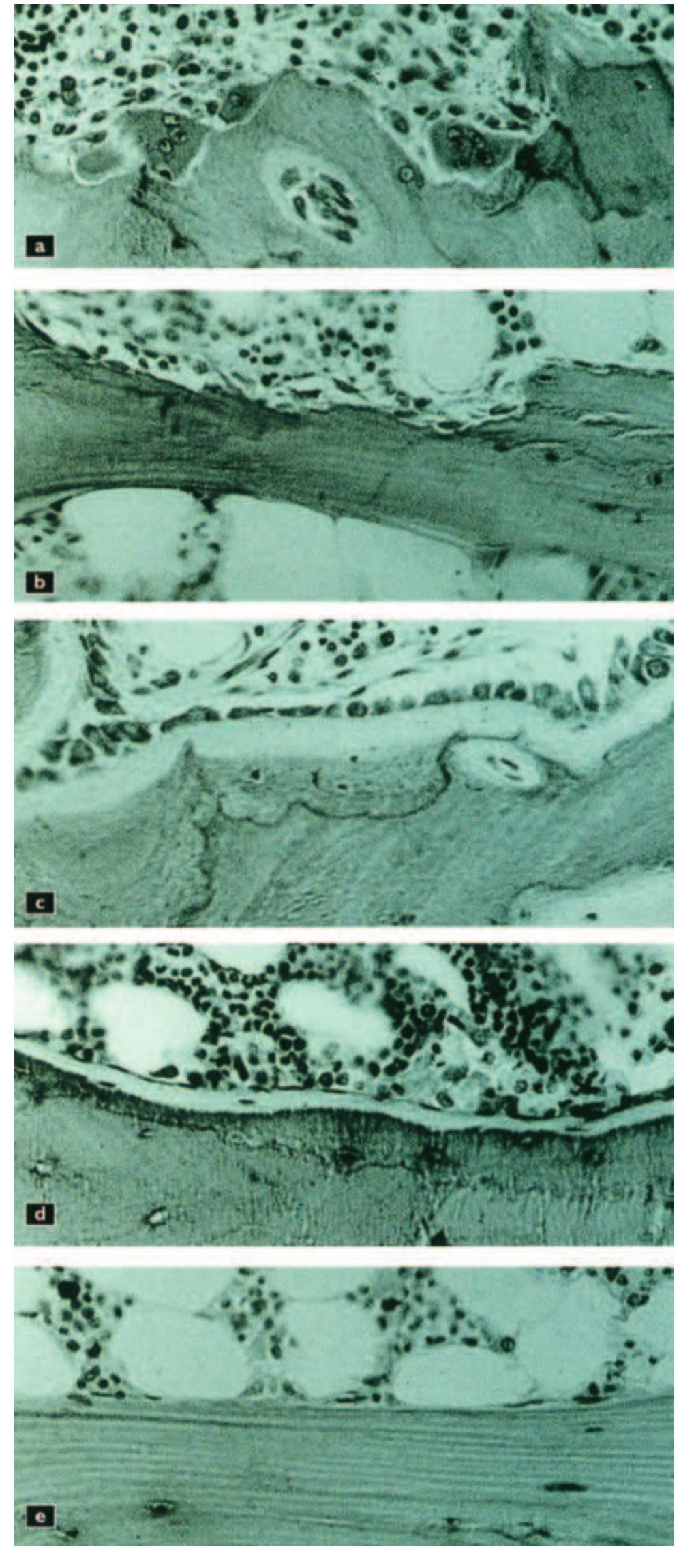 15 histological biopsy sections from the iliac crest show