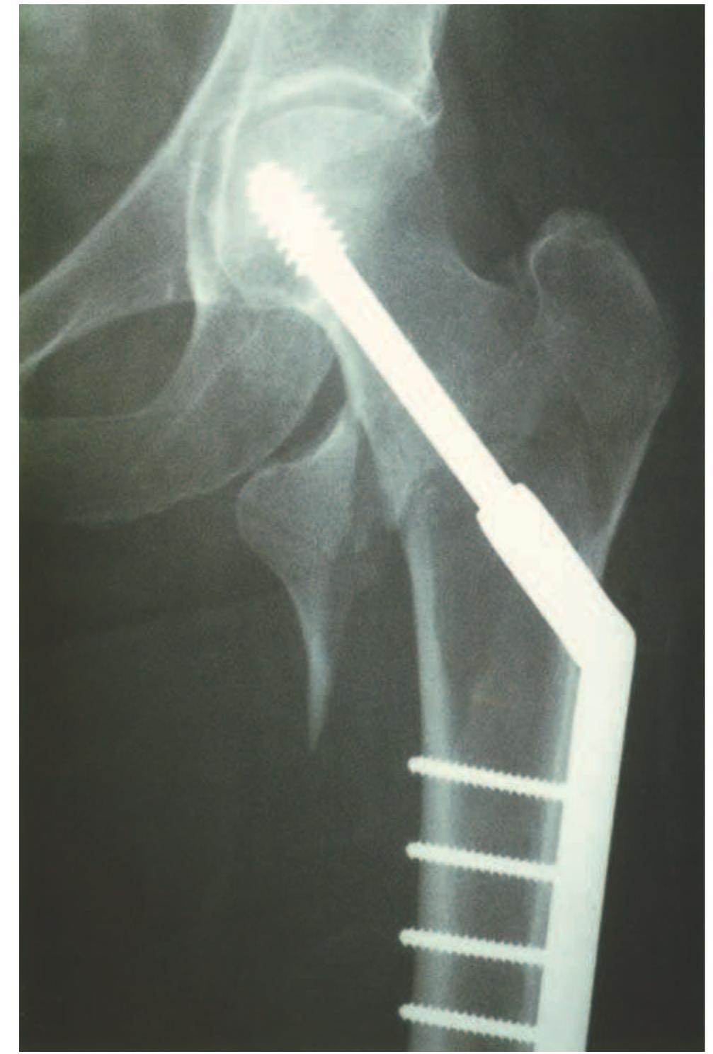6 radiograph of the proximal femur showing an extracapsular