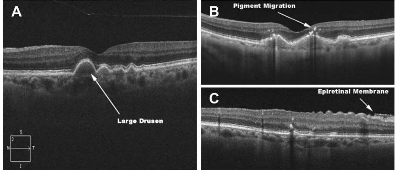 A: on optical coherence tomography (oct) (cirrus hd-oct;