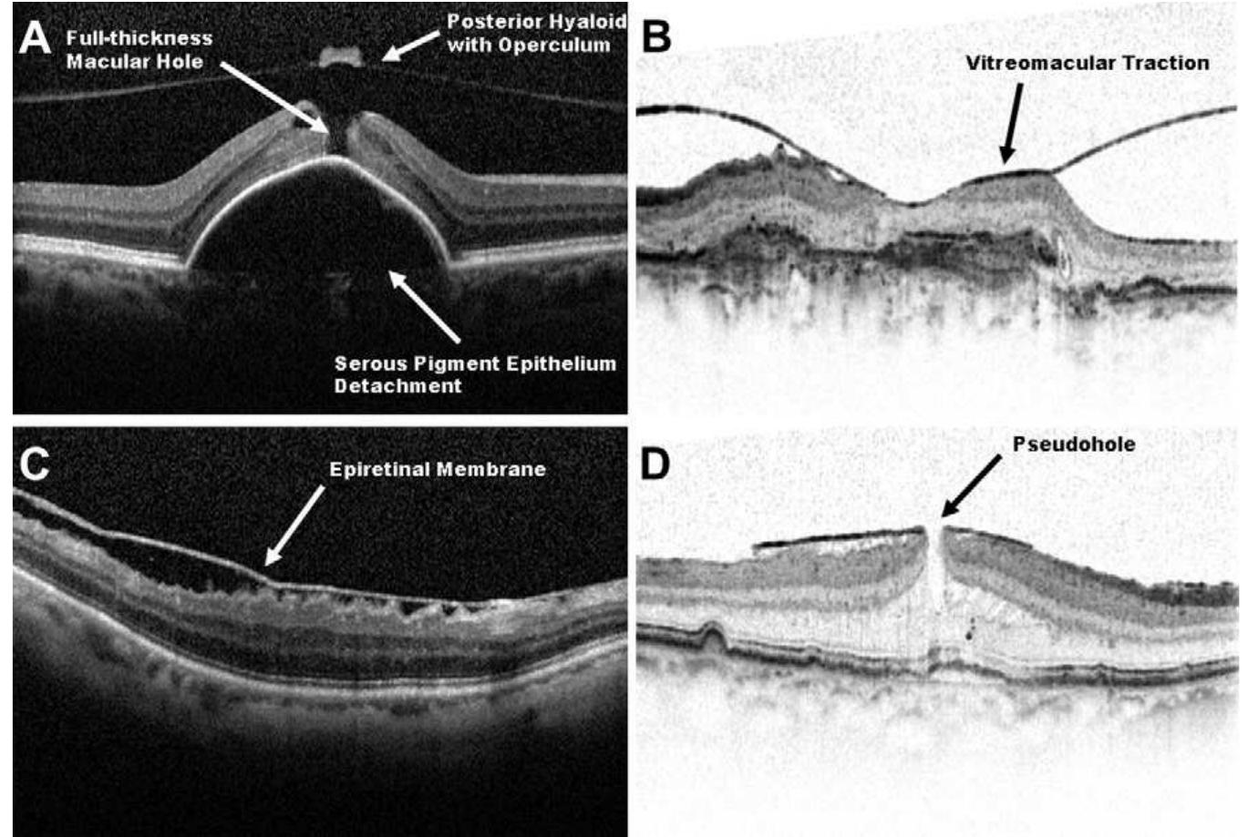 On optical coherence tomography (oct), vitreomacular