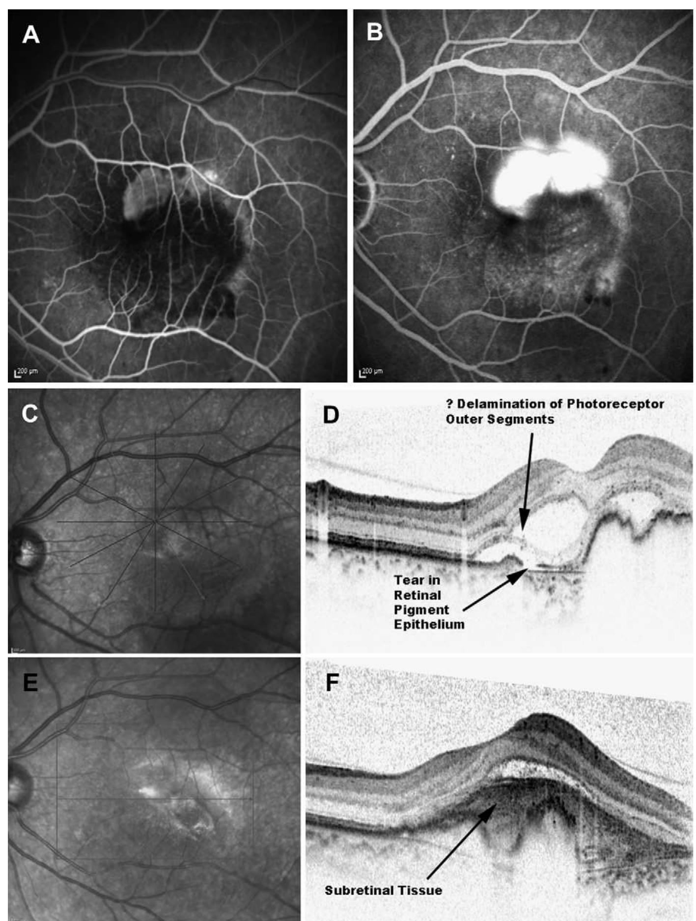 Tears in the retinal pigment epithelium (rpe) are a