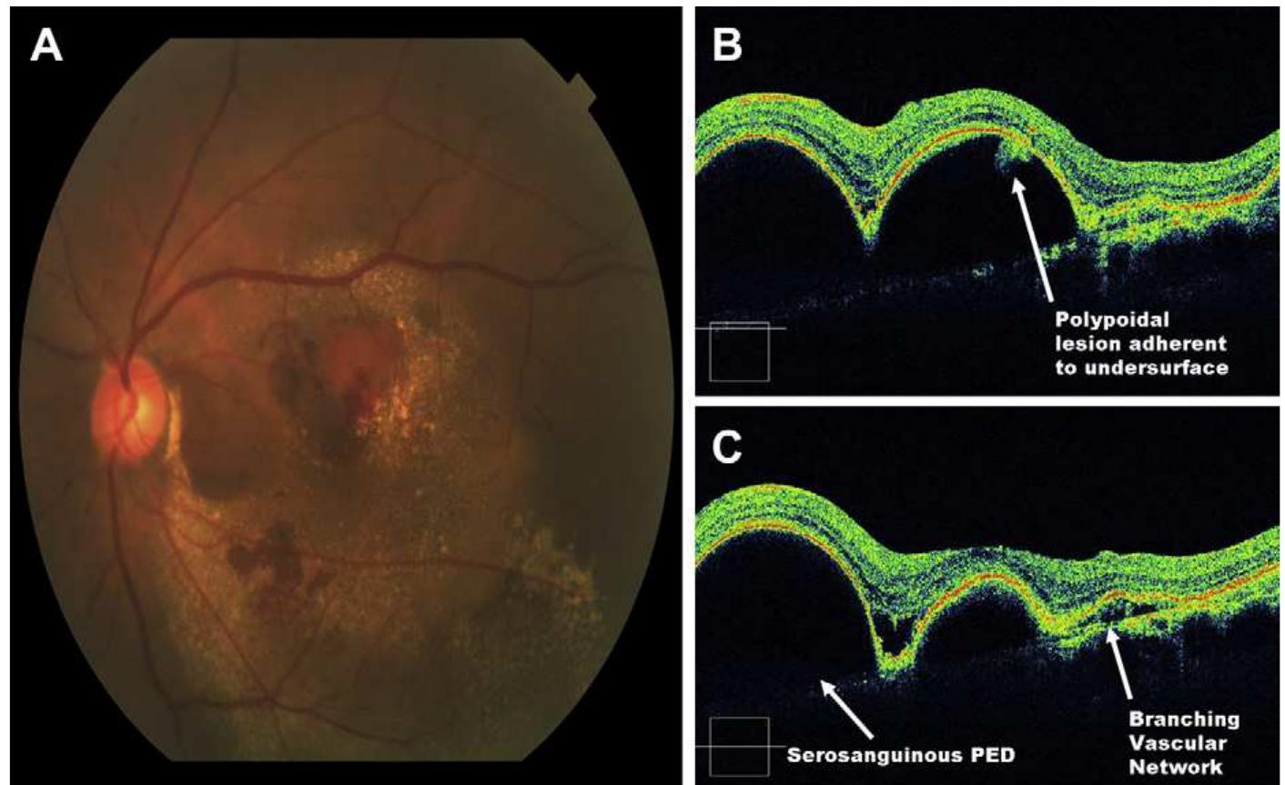 Polypoidal choroidal vasculopathy (pcv) is associated with a