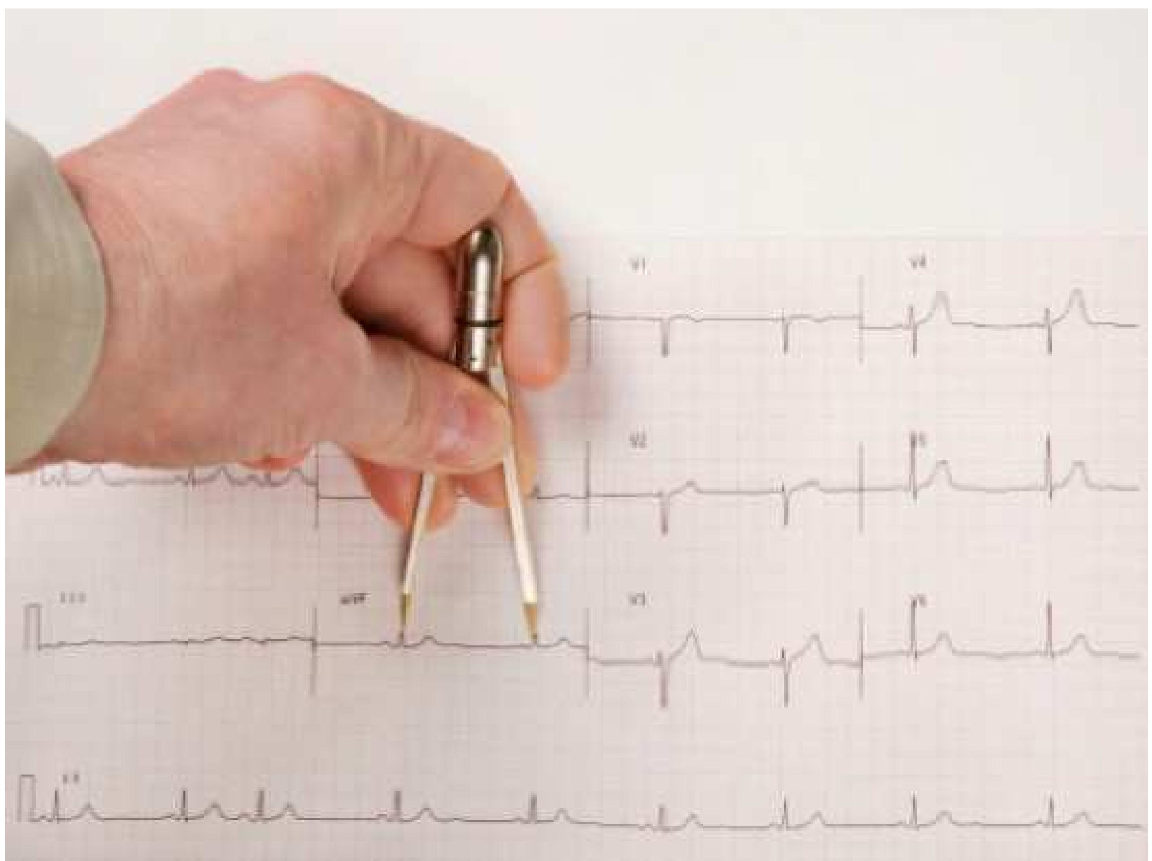 Figure 1 - 5 Steps to Rhythm Strip Interpretation