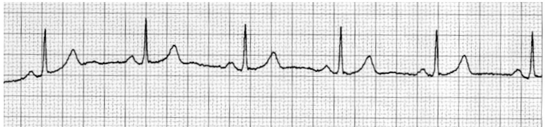 Figure 8 - 5 Steps to Rhythm Strip Interpretation