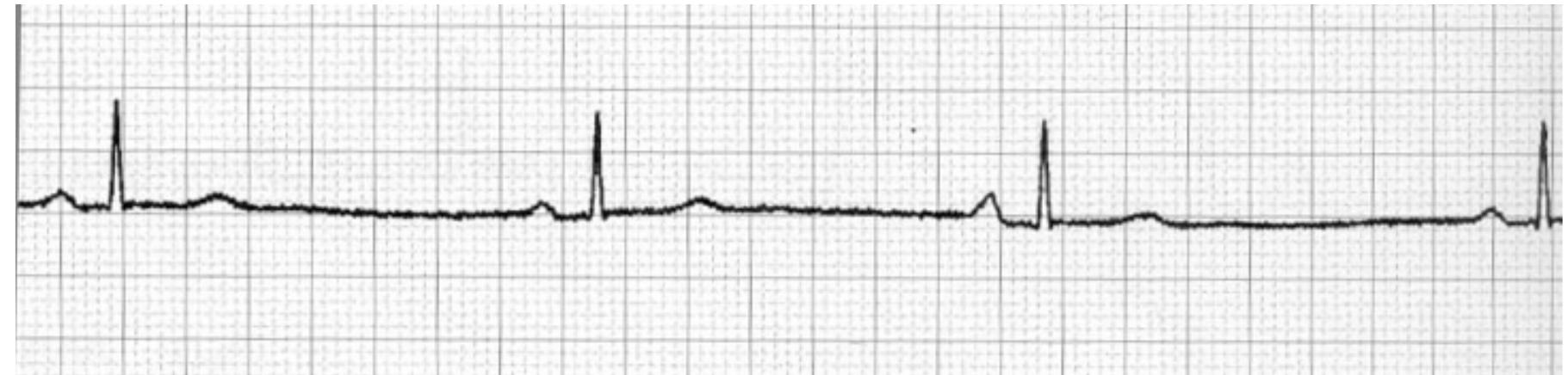 Figure 10 - 5 Steps to Rhythm Strip Interpretation