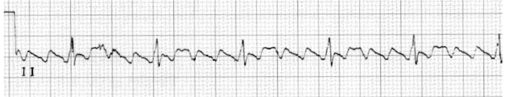 Figure 11 - 5 Steps to Rhythm Strip Interpretation