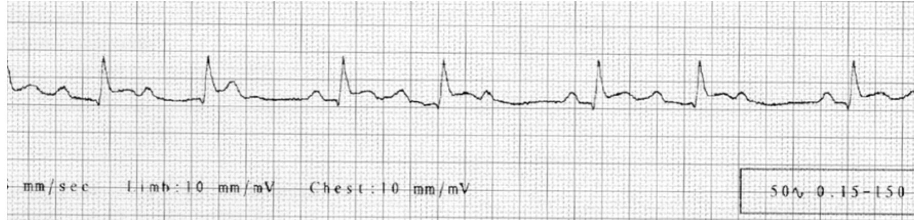 Figure 17 - 5 Steps to Rhythm Strip Interpretation