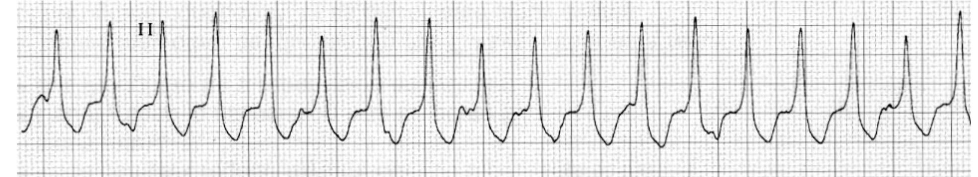 Figure 19 - 5 Steps to Rhythm Strip Interpretation
