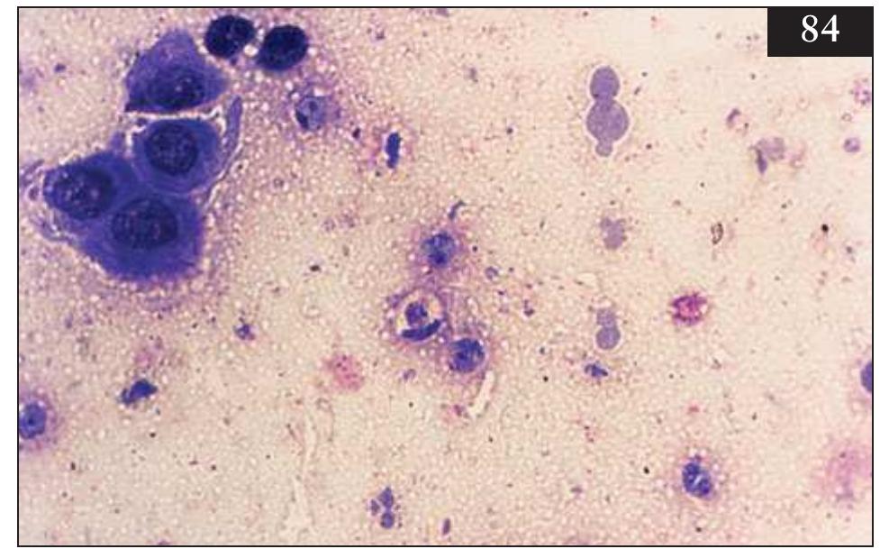 84 conjunctival cytology showing epithelial cells,