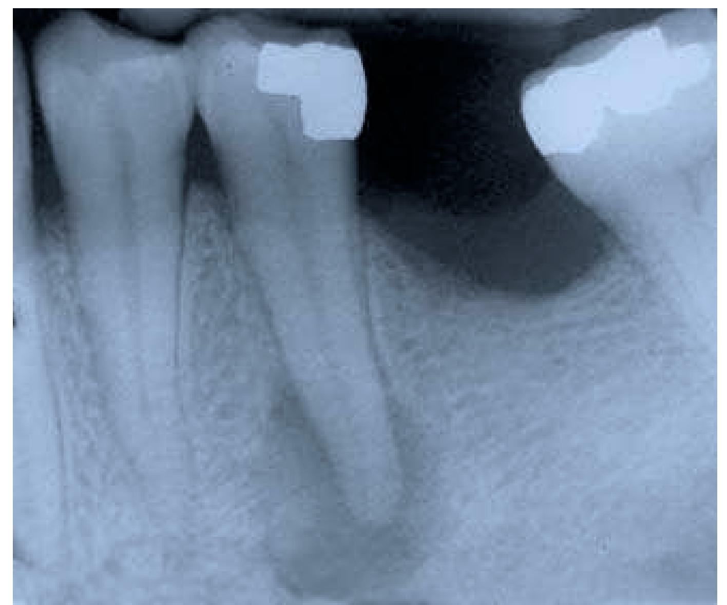 Figure 5 - from Etiologia clasificacion y patogenia de la