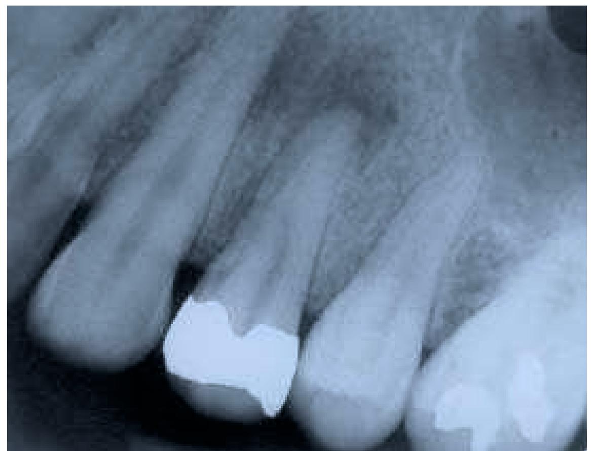 Imagen radiolticida periapical. periapical radiolucent