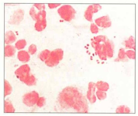 38 gram stained smear of cerebrospinal fluid showing pus