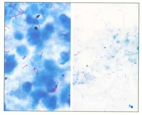56 mycobacterium tuberculosis acid fast bacilli (afb) in