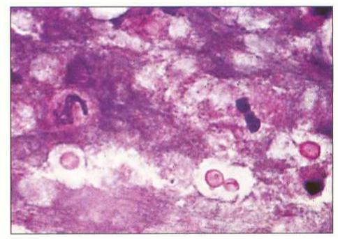 75 encapsulated cryptococcus neoformans in giemsa stained