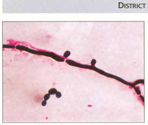 72 gram stained vaginal smear showing gram positive candida