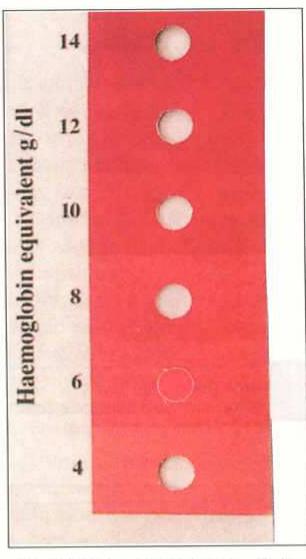 95 copack haemoglobin colour scale showing haemoglobin value