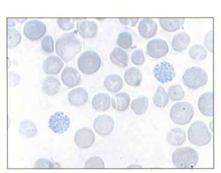1406 red cells showing pale staining hb h inclusions as seen