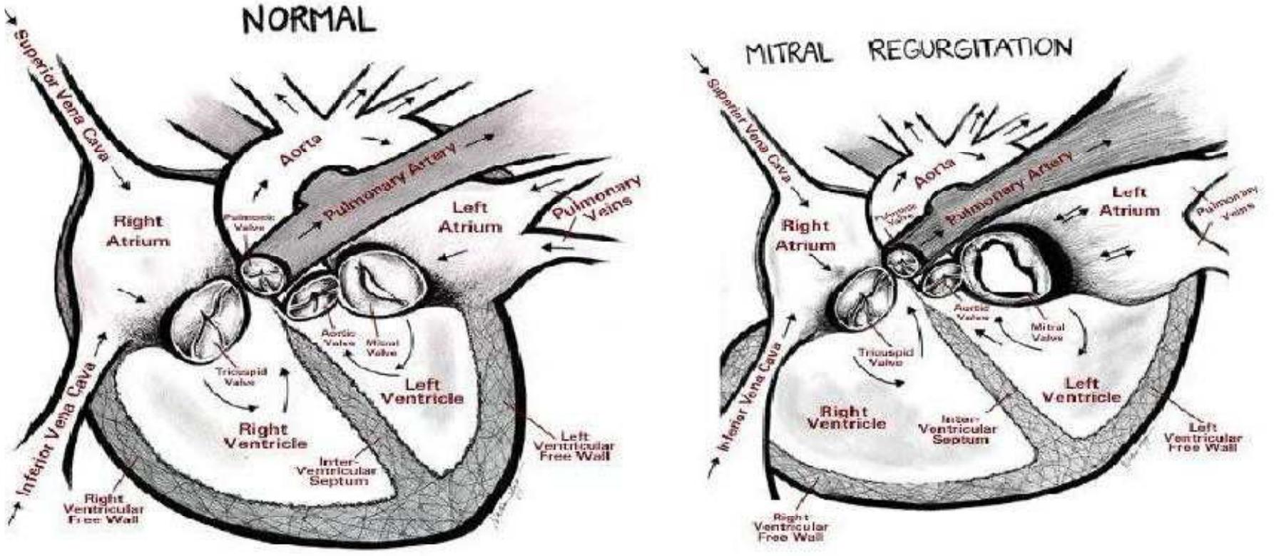 Schematic view of mitral regurgitation acceleration. on the