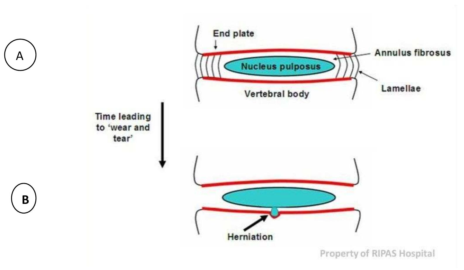 (a) normal disc, the pressure in nucleus pulposus prevents
