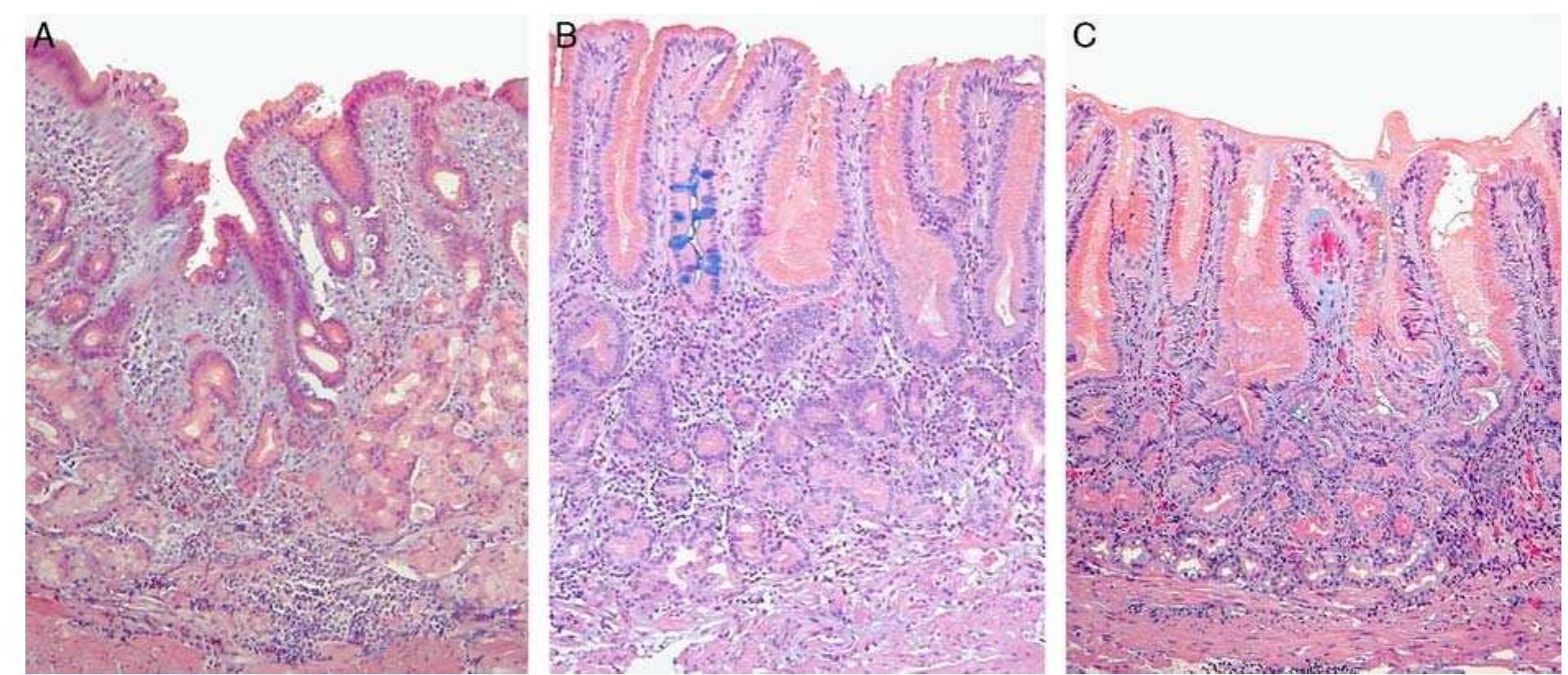 Corpus mucosa with different types of atrophy. a,