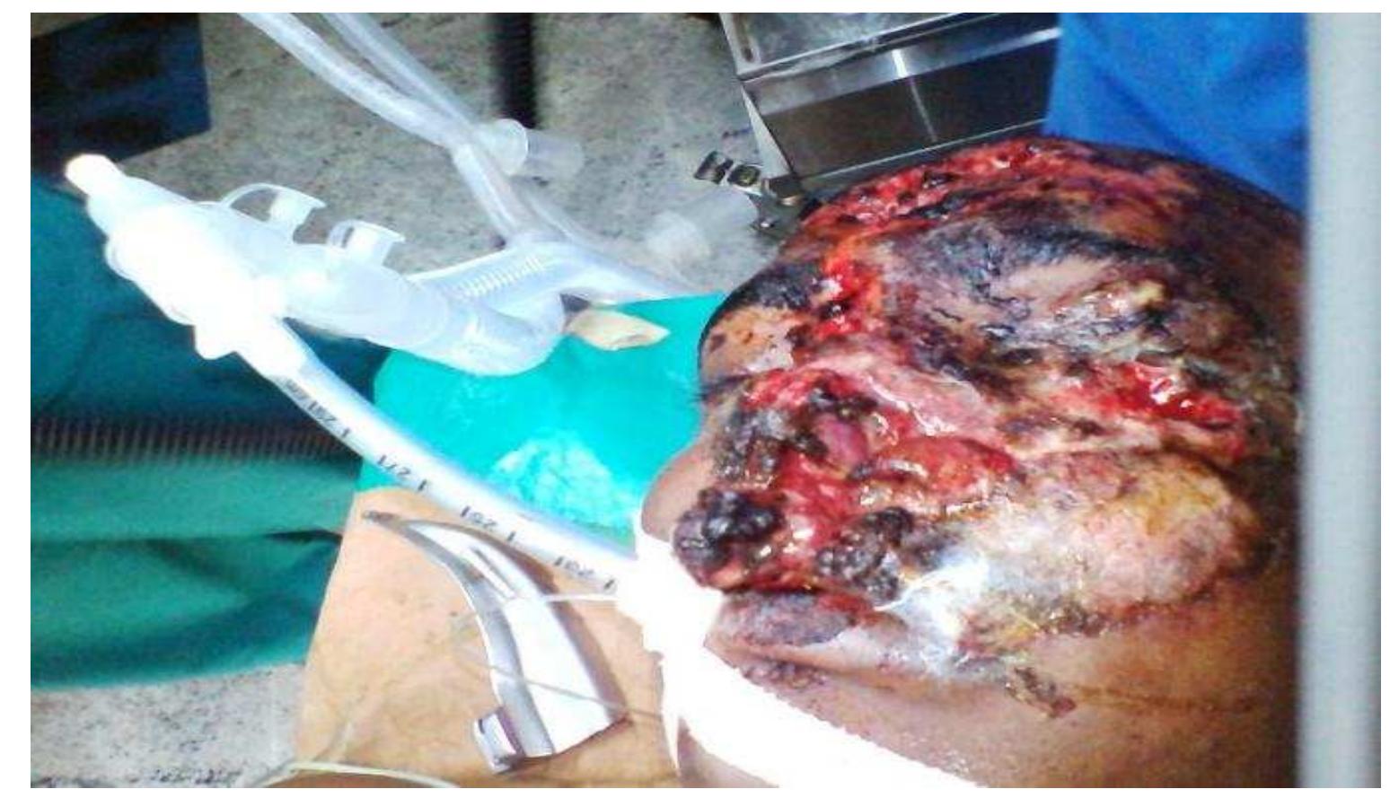 - successful intubation with conventional laryngoscopy using