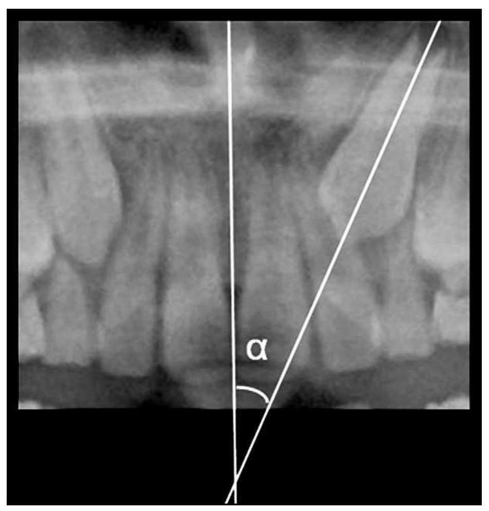 Inclination of the maxillary permanent canine (angle «) is
