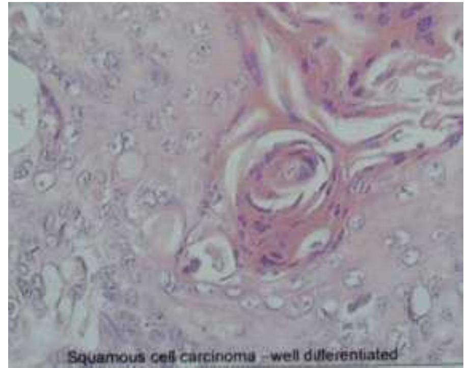 Histology of the skin lesion showing features of squamous