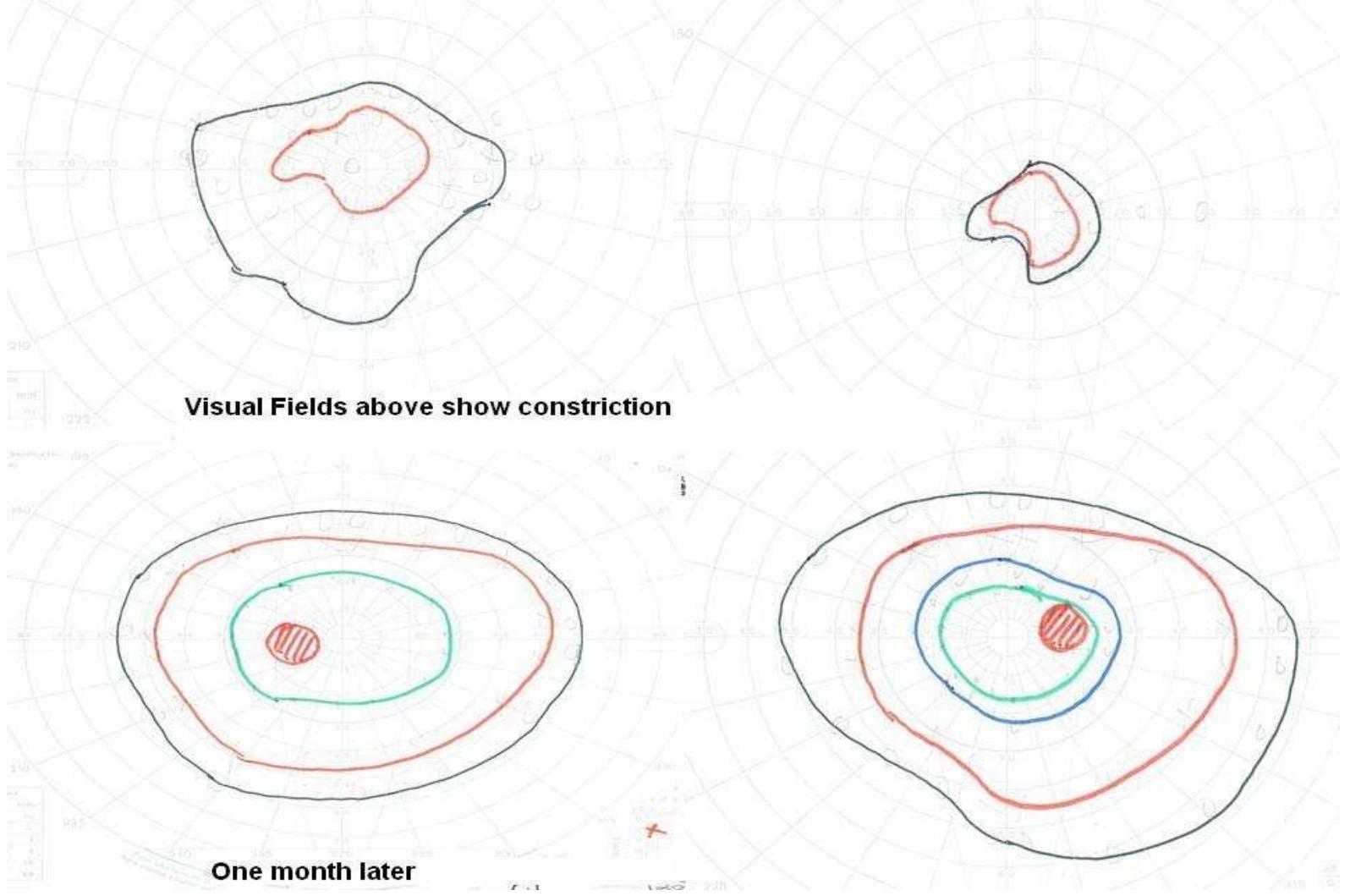 (PDF) Understanding Visual Fields: Goldmann Perimetry