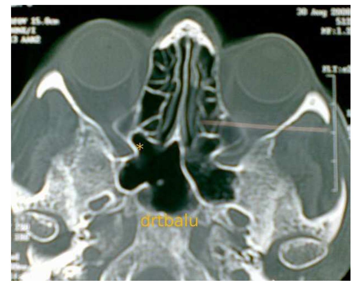 Axial ct image showing the onodi cell