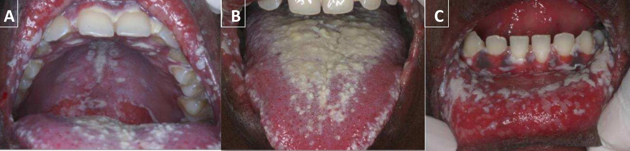 Figure 1 - from PSEUDOMEMBRANOUS CANDIDIASIS INDUCED BY LONG
