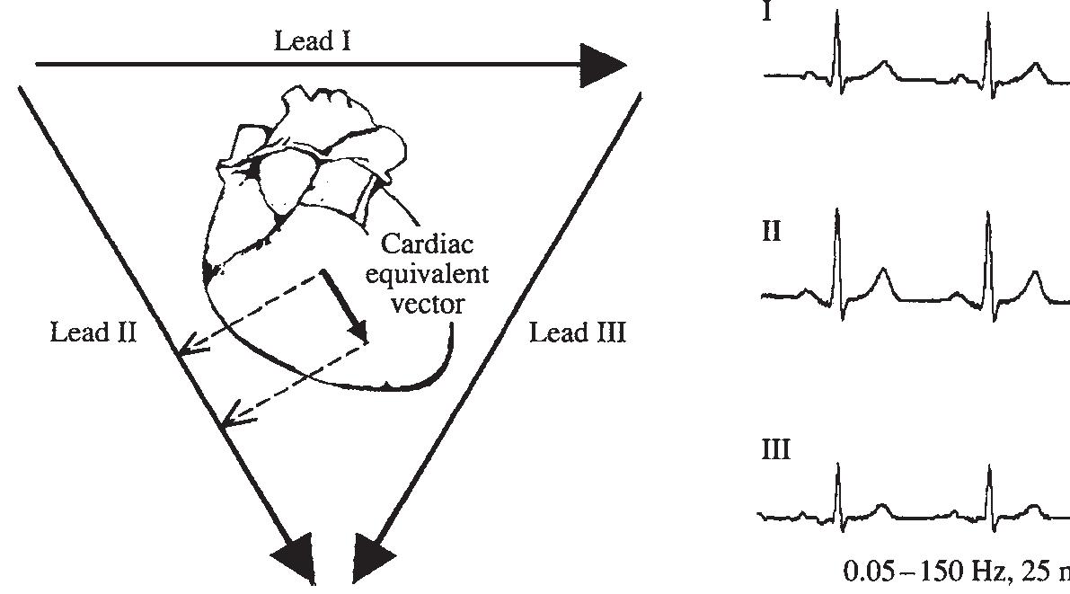 39 the normal ecg for leads i, ii, and iii. figure 17.38 the