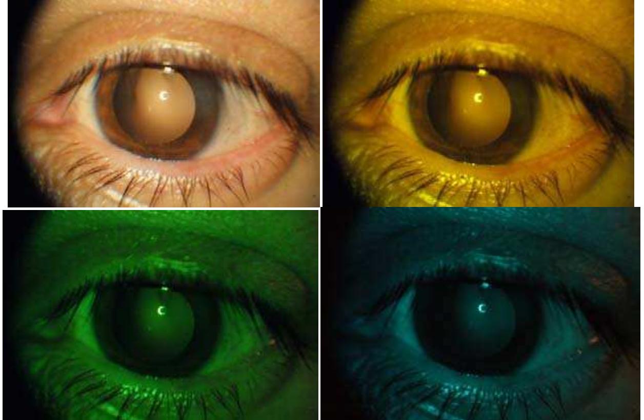 The melanin in the eye, in this case in the iris and lashes,