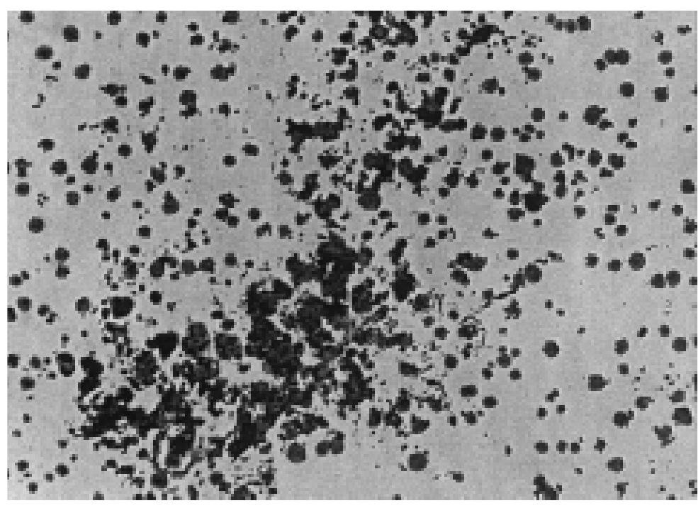 Ductile iron microstructure with a dross type defect. this