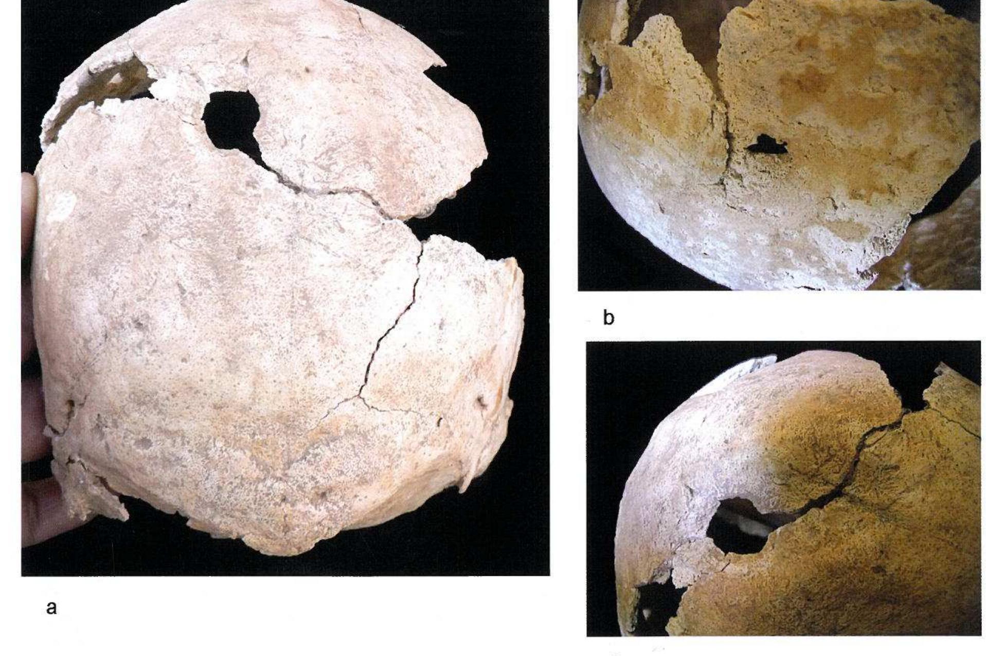 2. gero11.t20. a) cranium, showing two cranial lesions