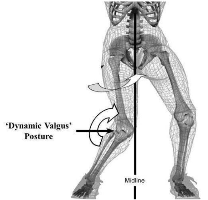 High risk ‘dynamic valgus’ knee posture, which is a