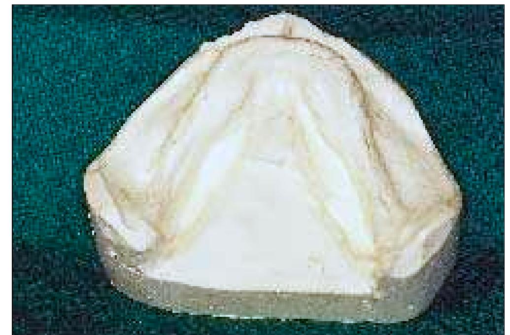 Final model of the mandibular arch.