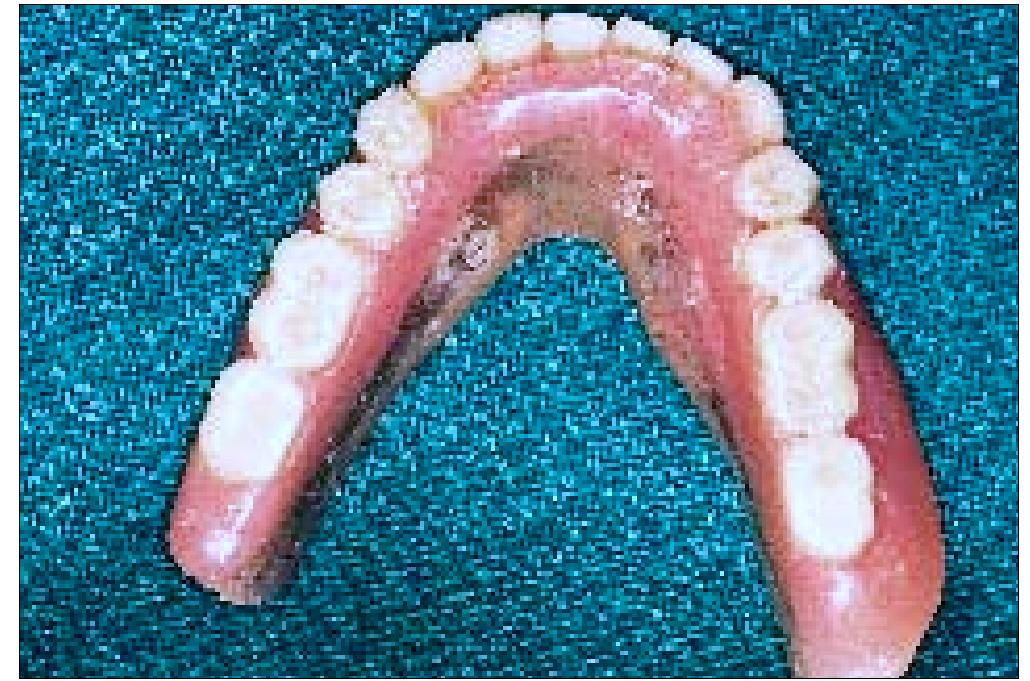 Mandibular denture with lingual flange fabricated in bitem