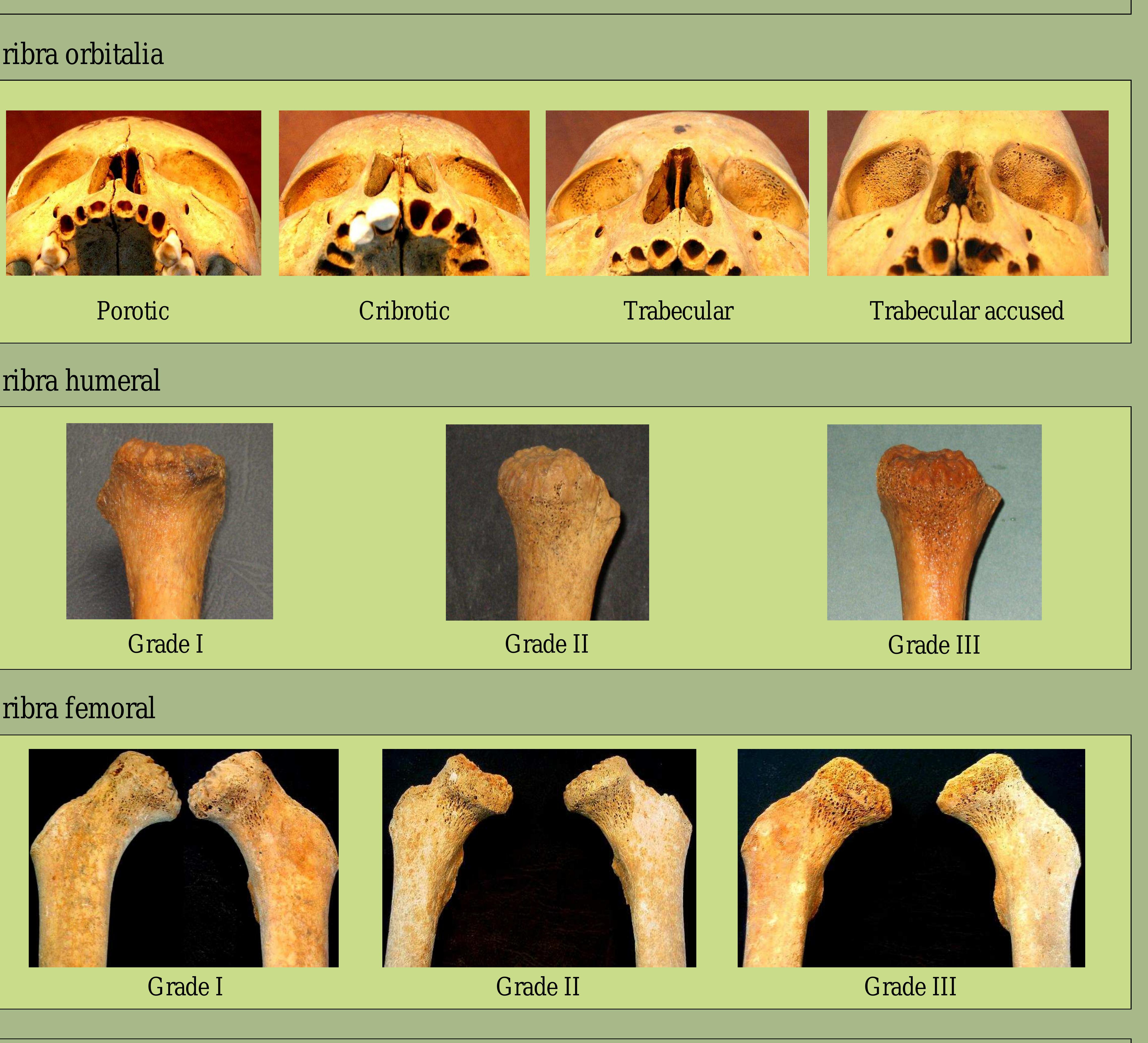 (PDF) The frequencies of cribra orbitalia, humeral and femoral cribra ...