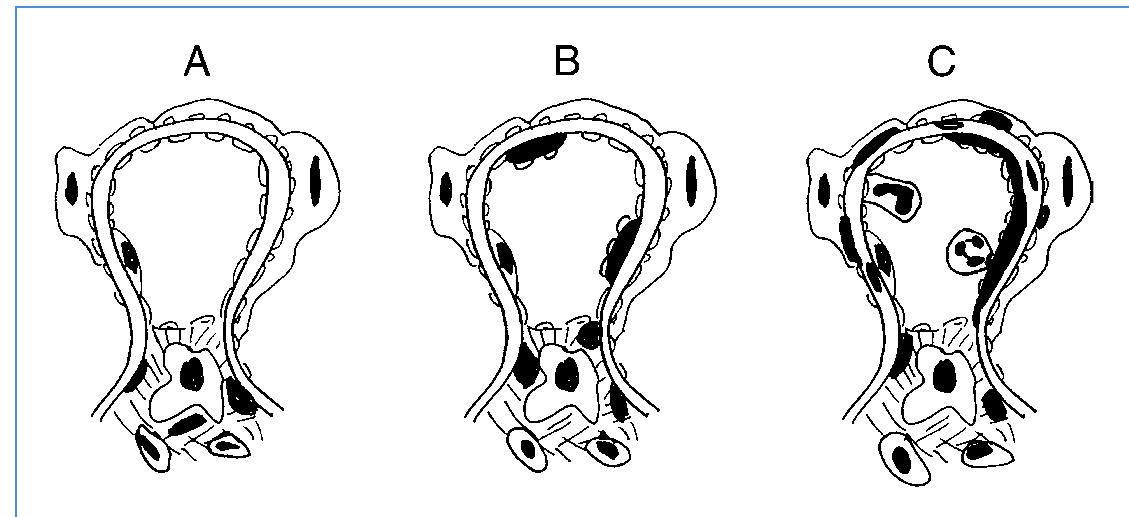 -7. lupus nephritis. a, class ii lesion. the glomerulus