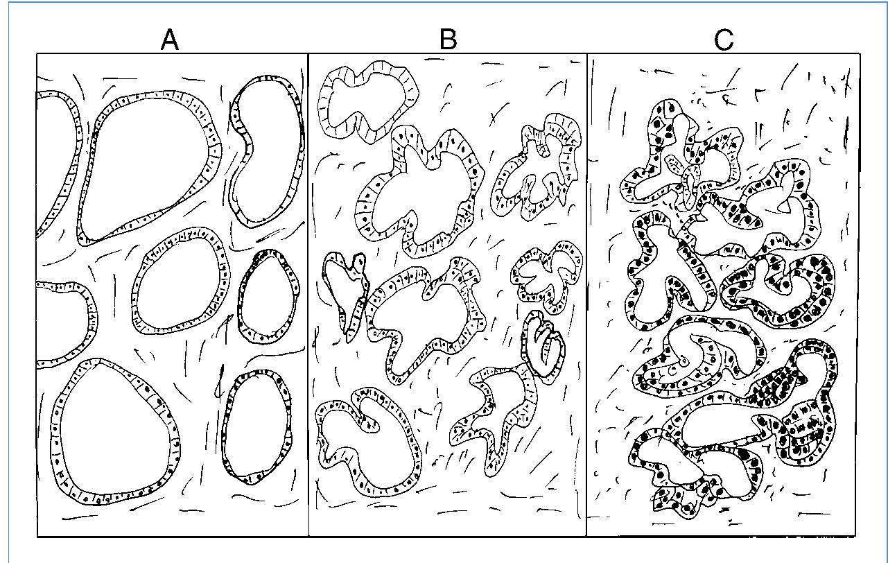 -2. endometrial hyperplasia. a, simple hyperplasia. the