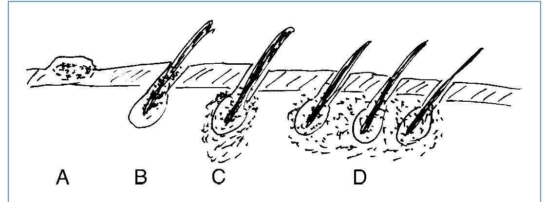 -5. skin lesions caused by purulent bacteria. a, impetigo is