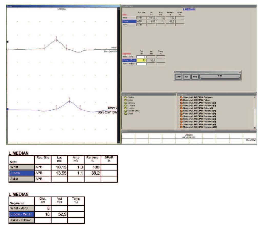 Emng: motor conduction velocity of nervus medianus