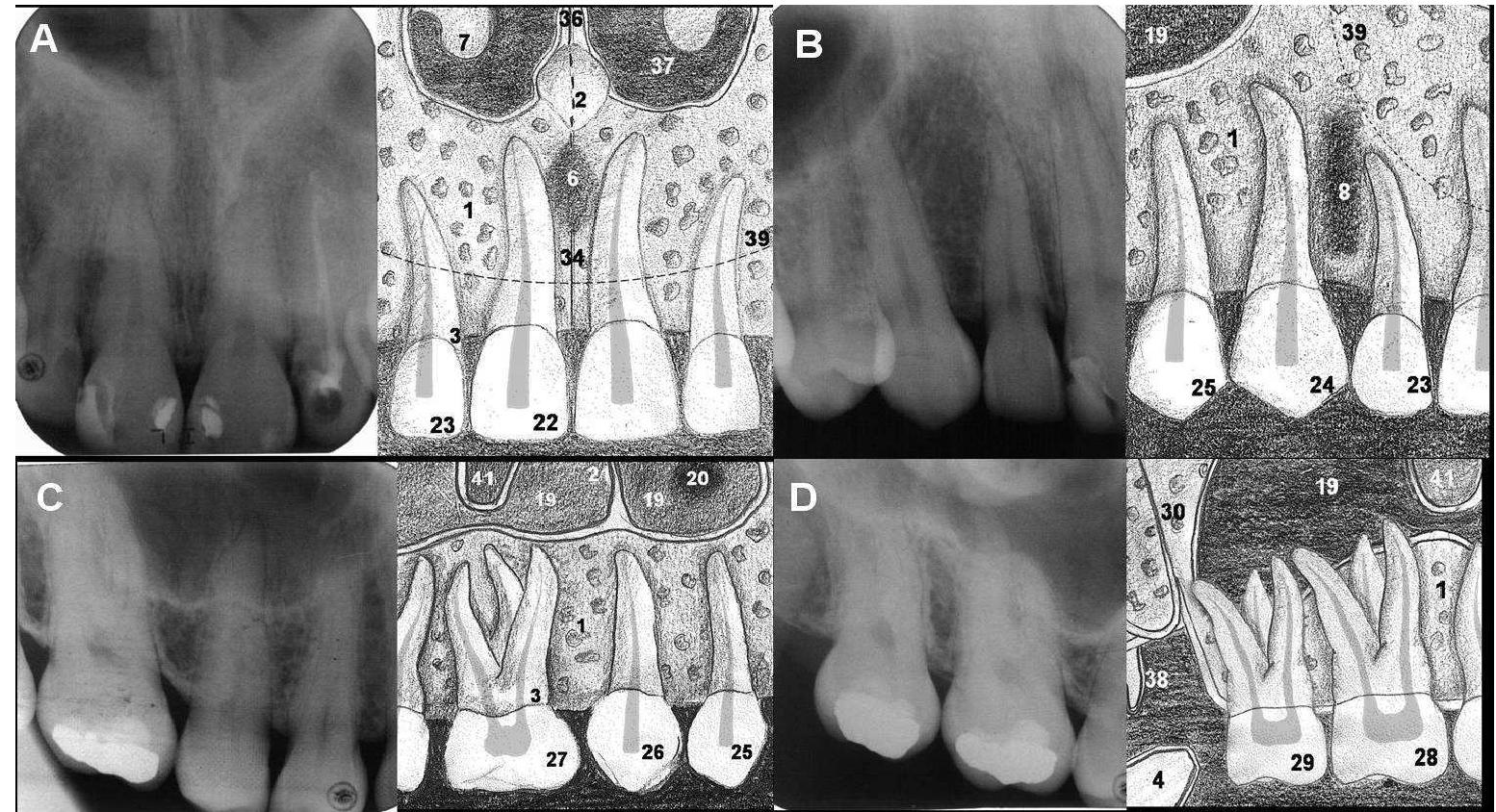 A: periapical view and schematic drawing of maxillary